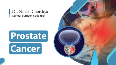 Stages And Treatments of Prostate Cancer- Dr. Nilesh Chordiya