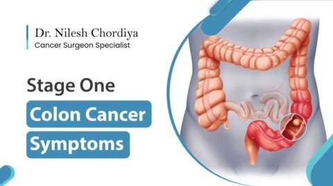 Stage One Colon Cancer Symptoms | Dr. Nilesh Chordiya